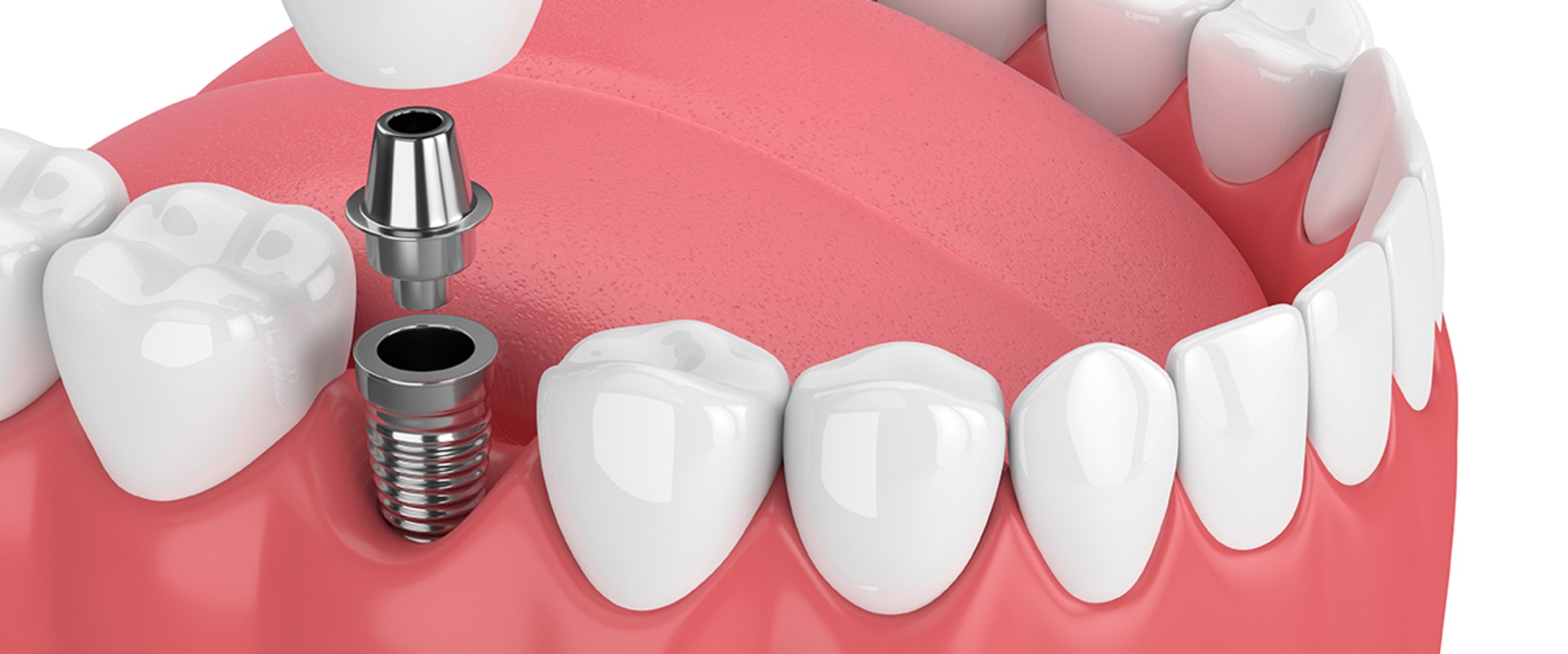 Dental Assistants Role In A Dental Implant Procedure In Texas